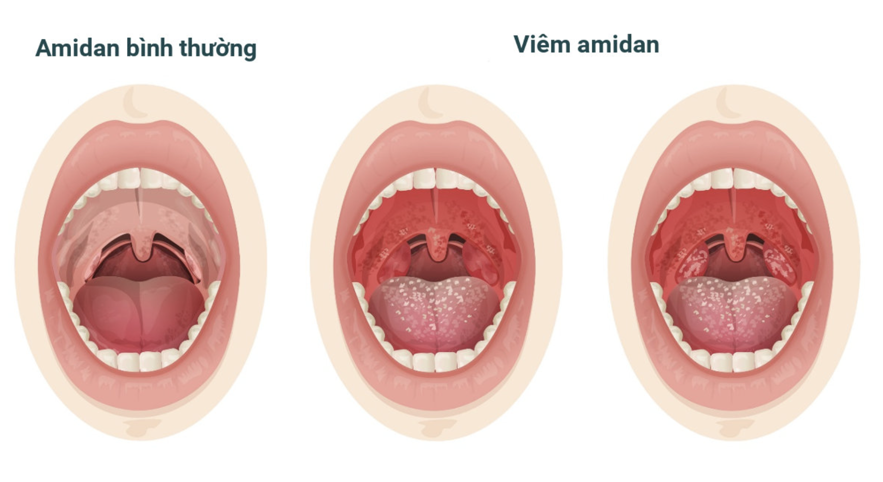 Dao Plasma dùng trong phẫu thuật Amidan và Nạo V.A - Nguyetcatmed.vn